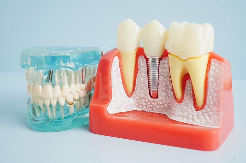 Revamp Your Smile: Understanding the Basics of Tooth Implants in McLean ...